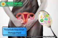 Menggali Keputihan Menggumpal dan Pengelolaan yang Tepat | Klinik ...