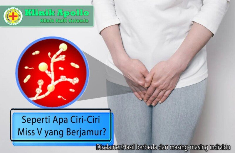 Waspadai Ciri-Ciri Miss V Berjamur | Klinik Apollo Jakarta