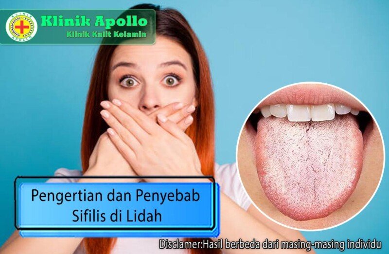 Ngeri! Sifilis di Lidah Bisa Timbulkan Luka | Klinik Apollo Jakarta