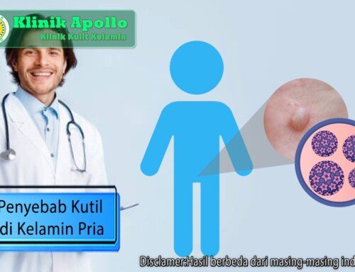 4 Penyebab dan 5 Gejala Balanitis Candidiasis dan Pengobatannya ...