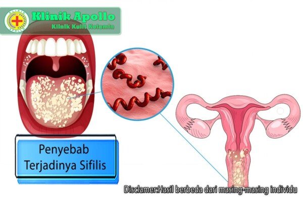 Penyakit Kelamin | Klinik Apollo Jakarta