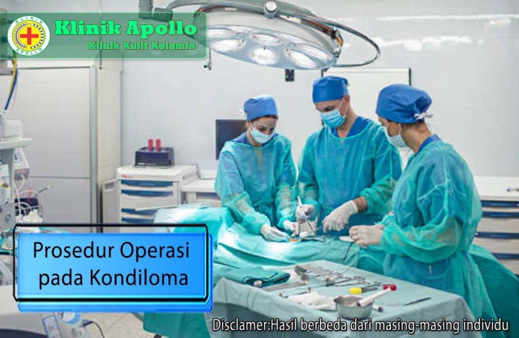 Operasi Kondiloma Akuminata dan Perawatan Pascaoperasi | Klinik Apollo ...