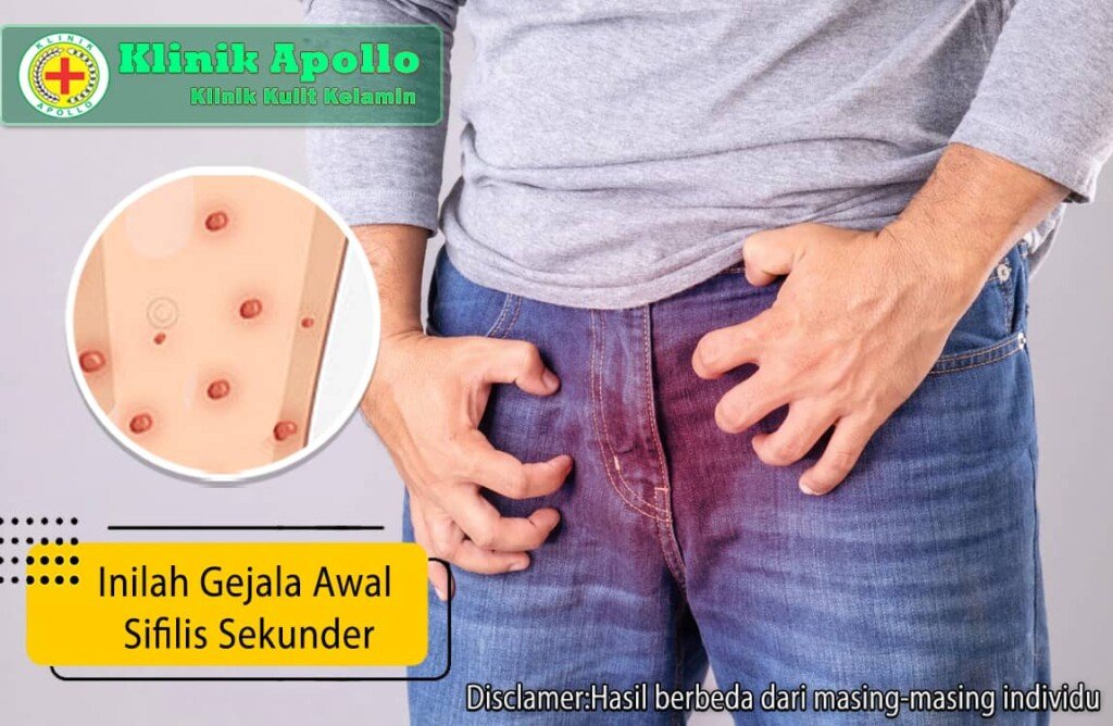 Gejala Sifilis Sekunder Pria, Simak Pengobatannya Dibawah Ini | Klinik ...