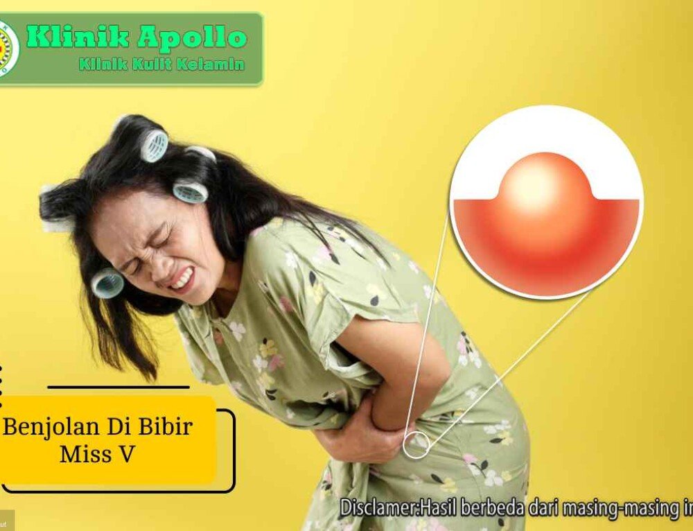 8 Penyebab Vulvovaginitis pada Wanita, Hindari Kebiasaan Ini! | Klinik Apollo Jakarta